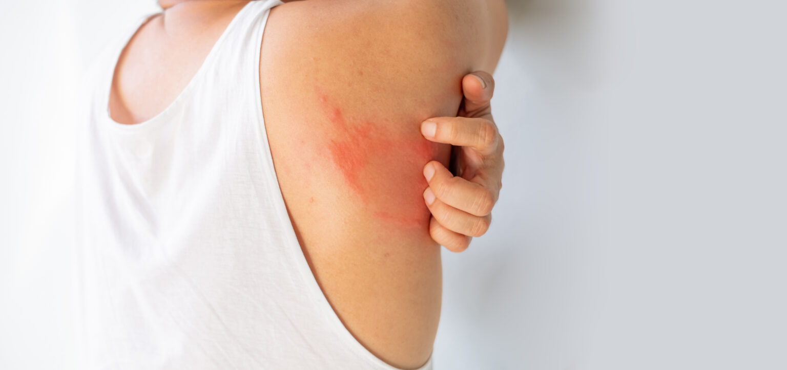 Dermatite da sudore: guida completa su sintomi, cause e trattamenti ...